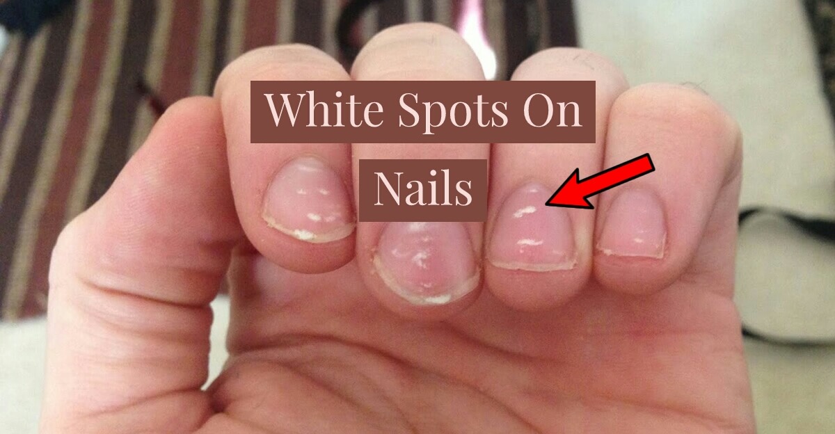 White Spots on Nails - Pritish Kumar Halder